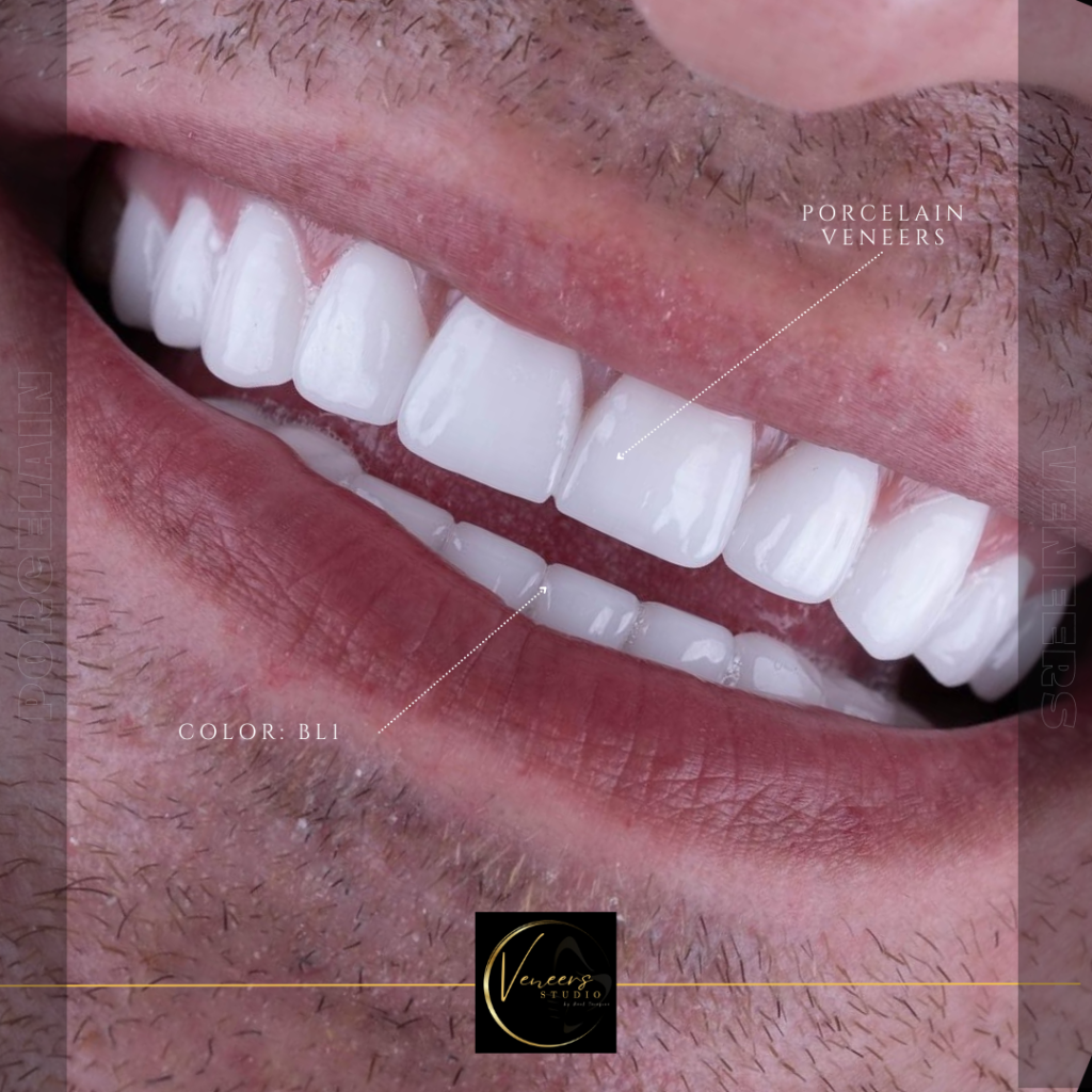 + Porcelain Veneers - veneers in colombia